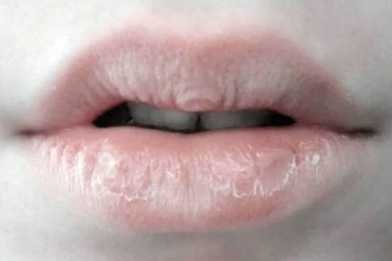 Don't Ignore These 10 Health Warning Signs Your Lips are Telling You ...