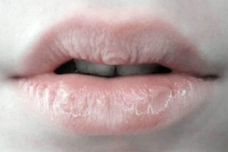 Don't Ignore These 10 Health Warning Signs Your Lips are Telling You ...