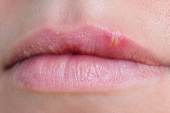 Dont Ignore These 10 Health Warning Signs Your Lips Are Telling You