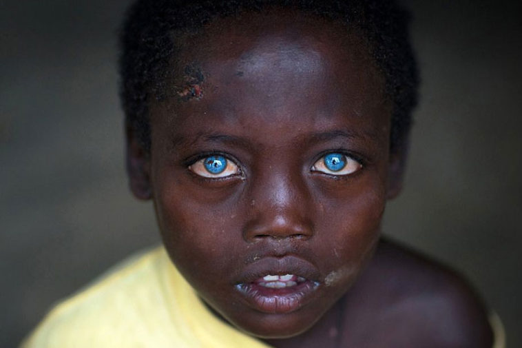 10 Amazing Human Features That Are Genetic Mutations - Page 10 of 10 ...