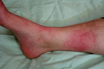 9 Signs Your Mystery Rash Is Something Serious - Factspedia