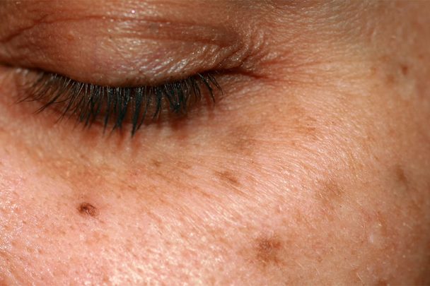 How Do You Know The Difference Between Age Spots And Skin Cancer ...