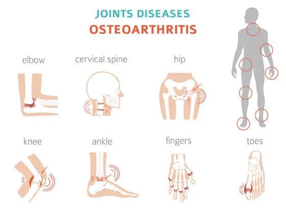 10 Types of Arthritis You Could Have - and How to Tell the Difference ...