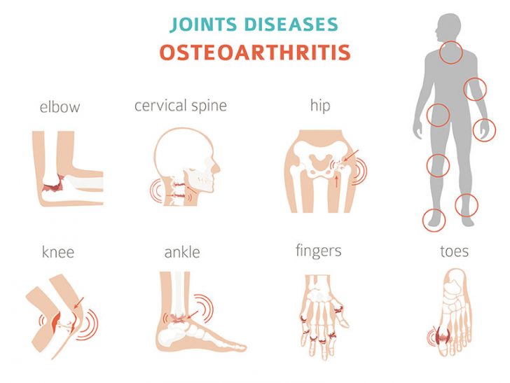 10 Types of Arthritis You Could Have - and How to Tell the Difference ...