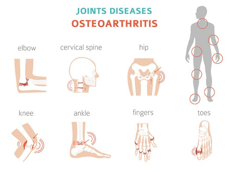 10 Types of Arthritis You Could Have - and How to Tell the Difference ...