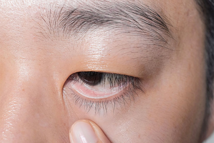 10 Things Your Eye Gunk Says About Your Health - Factspedia