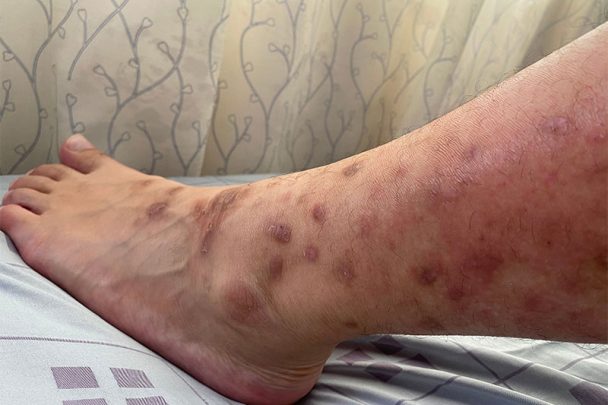 9 Signs Your Mystery Rash Is Something Serious - Factspedia