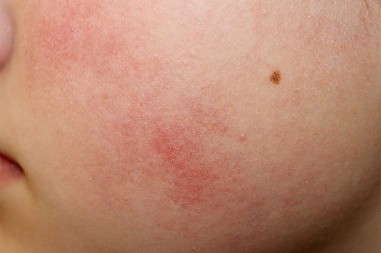 5 New Side Effects of Face Masks And How To Treat Them - Factspedia