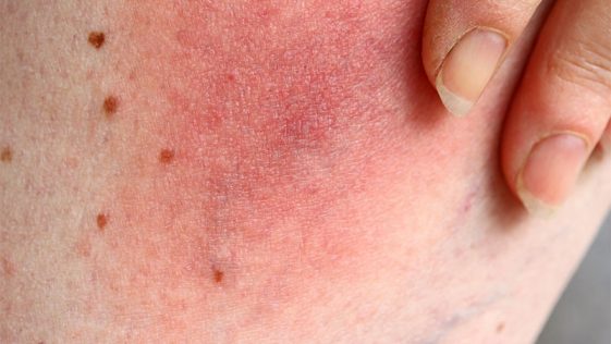 How Do You Know The Difference Between Age Spots And Skin Cancer ...