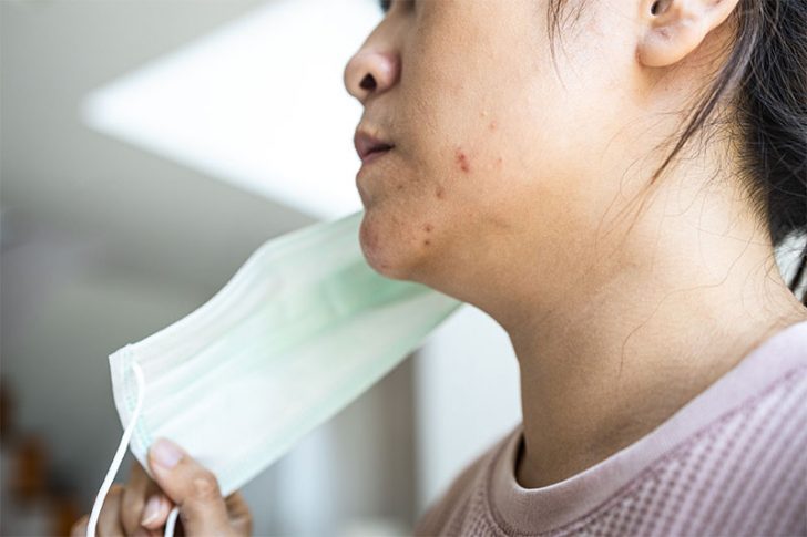 5 New Side Effects of Face Masks And How To Treat Them - Factspedia