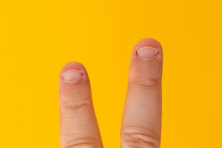 The Most Unusual Genetic Disorders on Earth - Factspedia