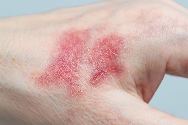 You Can Tell If A Cut Is Infected By Looking Out For These 5 Symptoms ...