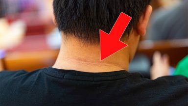 Do You Sometimes Have A Strange Little Bump Behind Your Ear This Is