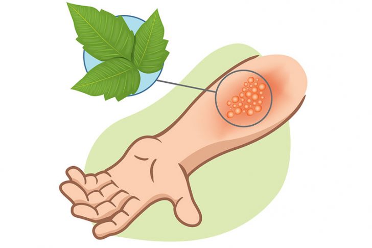 9 Signs Your Mystery Rash Is Something Serious - Factspedia