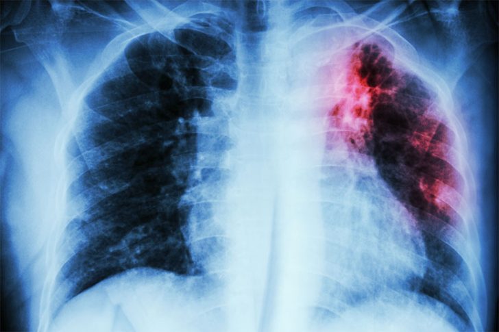 12 Warning Signs Your Lungs Are Yelling for Immediate Help - Factspedia