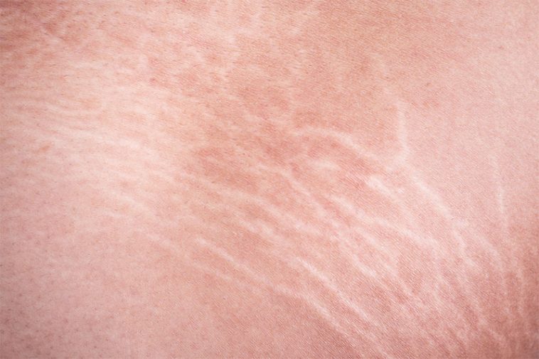 How Do You Get Rid Of Stretch Marks? - Factspedia
