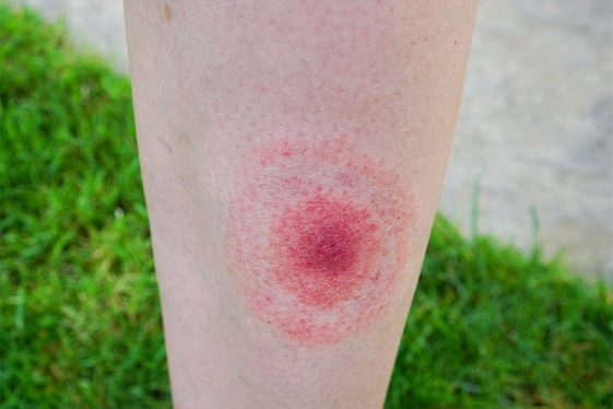 9 Signs Your Mystery Rash Is Something Serious - Factspedia