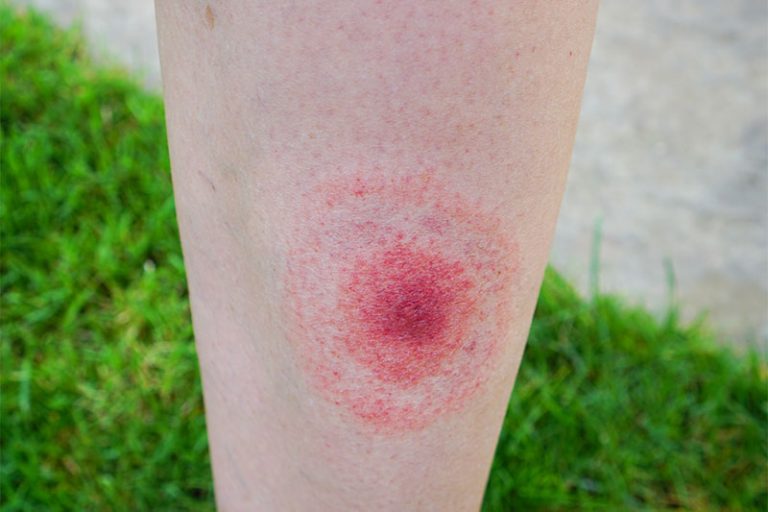 9 Signs Your Mystery Rash Is Something Serious - Factspedia