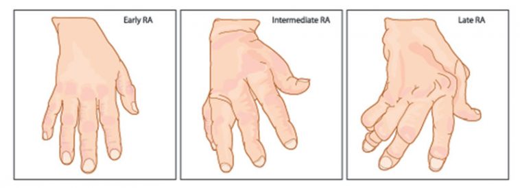 10 Types of Arthritis You Could Have - and How to Tell the Difference ...