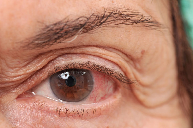 10 Things Your Eye Gunk Says About Your Health - Factspedia