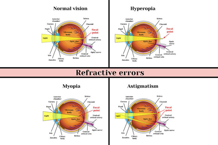 The 7 Most Common Vision Problems And How To Prevent Them - Factspedia