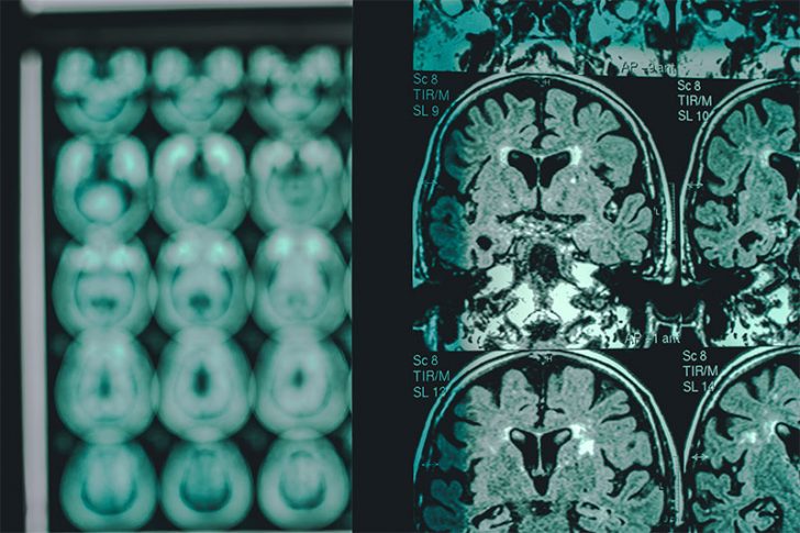 15 Things Neurologists Do To Prevent Alzheimer’s Disease - Factspedia