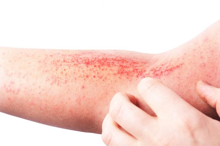 10 Times You Should Never, Ever Scratch an Itch - Factspedia
