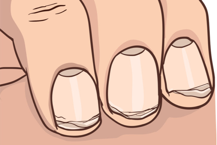 If You Have This Mark on Your Nail, You Should Get Checked for Cancer ...